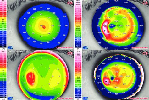 Topography Of The Left Eye Showing Excess Flattening In The Area Of Download Scientific Diagram