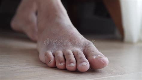 Close Up Swelling Of The Tongue Allergic Reactions Infections Angioedema Trauma Or Injury