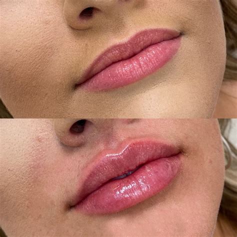Lip Filler Before And After Ботокс губы Косметолог Инъекции губ