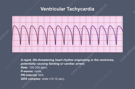 Ventricular Tachycardia Heartbeat Rhythm Illustration Stock Image F041 7753 Science Photo