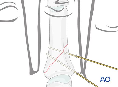 K Wire Fixation For Oblique Extraarticular Fracture Of The Proximal End Segment