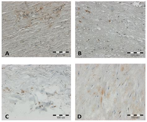 Association Between Leukocyte Cell Derived Chemotaxin 2 And Metabolic