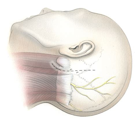 Retrosigmoid Approach Skull Base Surgery Atlas