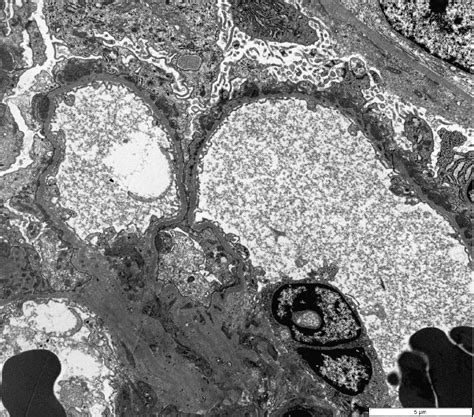 Membranous Glomerulonephropathy Atlas Of Renal Lesions In Proteinuric