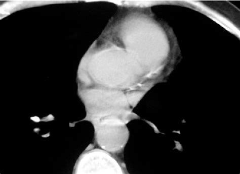 Figure 1 From Visually Scored Calcifications In Thoracic Arteries