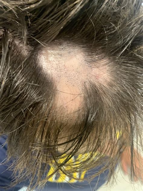 2 Months On Olumiant Details In Comments Ralopeciaareata