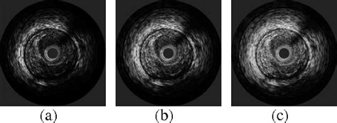 Figure 1 From In Vivo Ivus Tissue Classification A Comparison Between