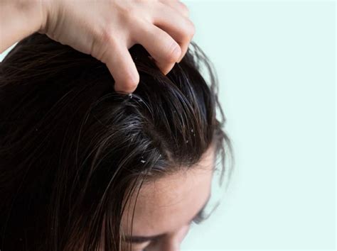 Scabby Scalp Causes Symptoms And Treatment