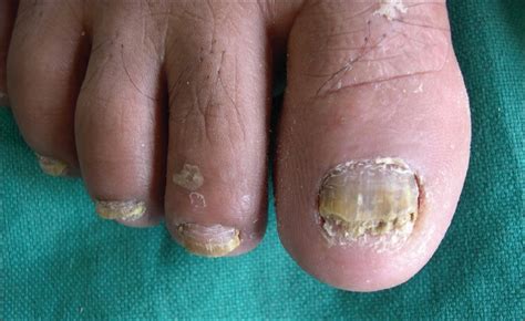 Subungual Hyperkeratosis Nail Biopsy A Better Diagnostic Tool For