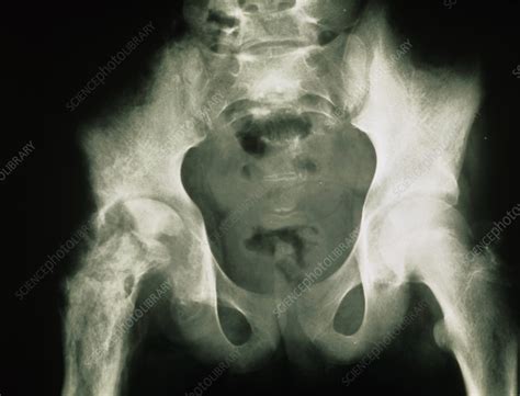 Septic Arthritis Hip
