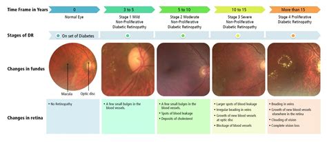 Diabetic Retinopathy Grading