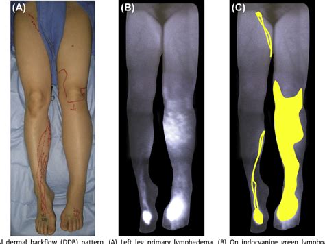Lymphedema Lower Extremities Semantic Scholar