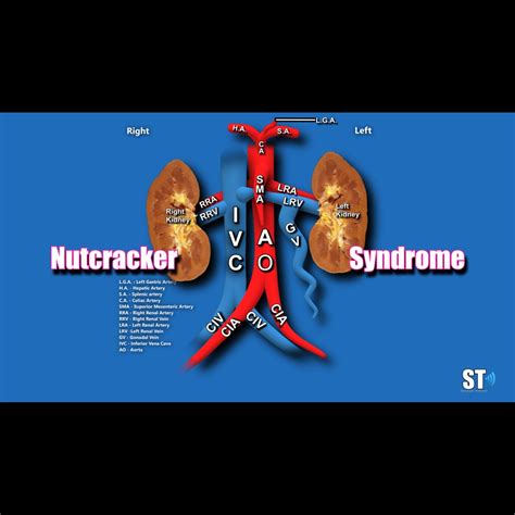 Nutcracker Phenomenonsyndrome Sonographic Tendencies