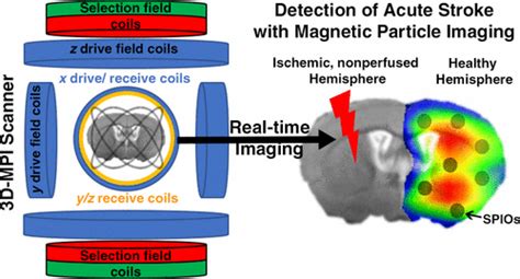 Magnetic Particle Imaging For Real Time Perfusion Imaging In Acute Strokeacs Nano X Mol
