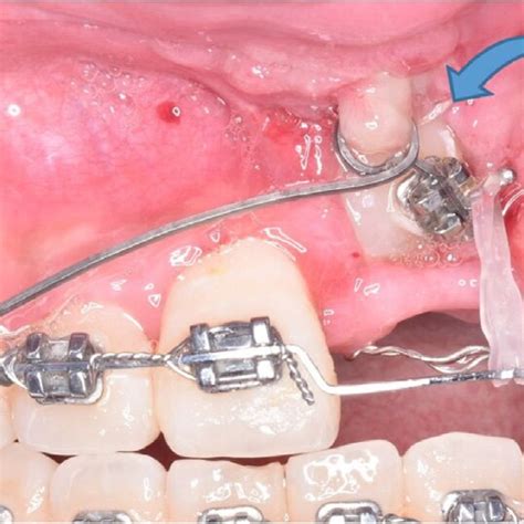 Second Stage Surgical Exposure With Apically Positioned Flap Apf