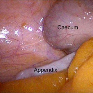 Laparoscopic View Of The Vermiform Appendix Pelvic Position Download Scientific Diagram