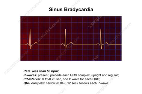 Sinus Bradycardia Heartbeat Rhythm Illustration Stock Image F041