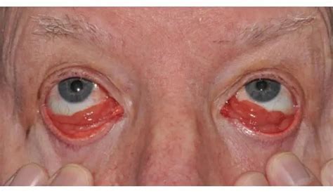 Conjunctival Lymphoma An Eye Care Blog
