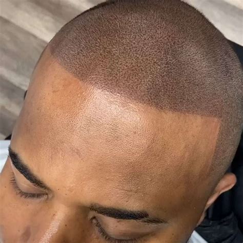 Smp For Men Scalp Micro Nj