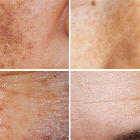 Does Sun Damage Cause Wrinkles At Xavier Guerard Blog