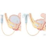 Urodynamic Testing Simple