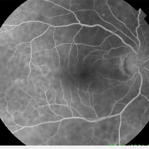 Ffa Of The Right Eye Shows A Normal Angiogram Download Scientific