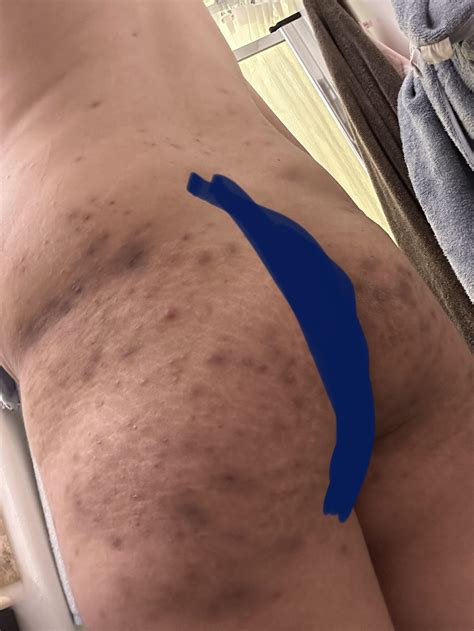 Does This Look Like Folliculitis Or Something Else Appeared On Buttocks Only Itches Very