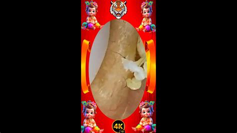 Blackheads And Whitehead Removal Acne Treatment And Very Satisfying Satisfying Pimple Pop