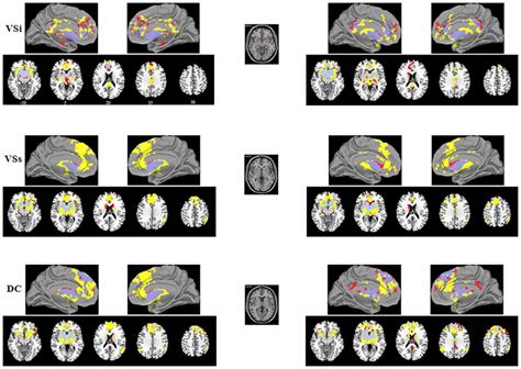 Functional Connectivity Fc Maps Of The Caudate Seeds For Each Group Download Scientific