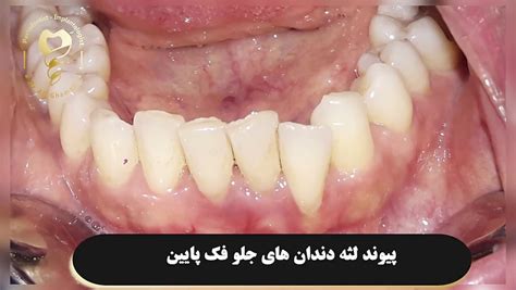 پیوند لثه دندان های جلو فک پایین
