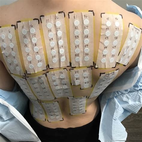 Allergy Patch Testing Dermatology Specialists Of Spokane