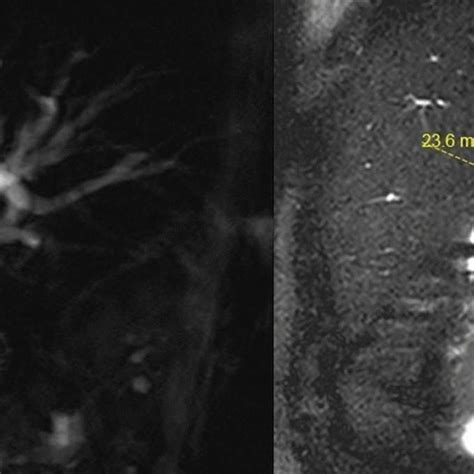 Magnetic Resonance Mr Cholangiography Showing A Dilated Intrahepatic Download Scientific