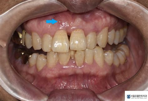서울유플란트 하루에 완성되는 앞니 임플란트 Feat 수술 후 임시치아 완성 네이버 블로그