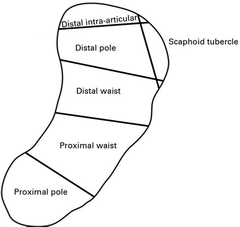 The Epidemiology Of Fractures Of The Scaphoid Bone And Joint