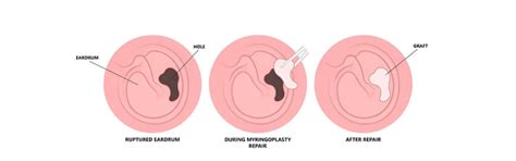 Perforated Eardrum Dr Murali Mahadevan Ent Surgeon