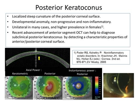 Posterior Keratoconus