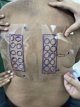 Various Techniques For Marking Patch Test Sites Indian Journal Of Dermatology Venereology And