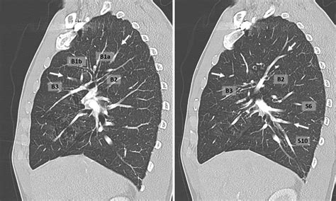 4 Sagittal Reconstructions Of The Right Lung Showing Segmental Bronchi Download Scientific