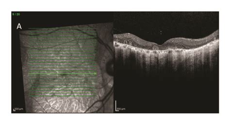 A And B Sdoct Shows Outer Retinal And Choriocapillaris Atrophy With