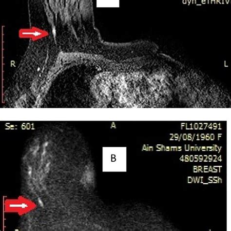 Case With Previous History Left Modified Radical Mastectomy 2 Year Ago