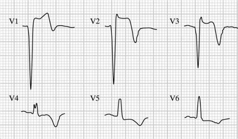 Left Ventricular Aneurysm • Litfl • Ecg Library Diagnosis