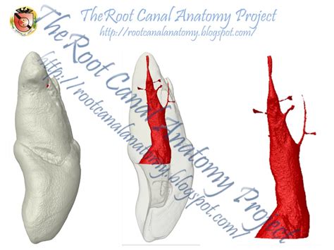 The Root Canal Anatomy Project Two Rooted Maxillary Central Incisor