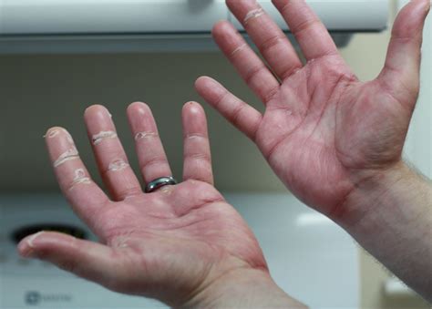 Soothe Hand Foot Syndrome Gentle Skin Relief After Chemotherapy Beecure