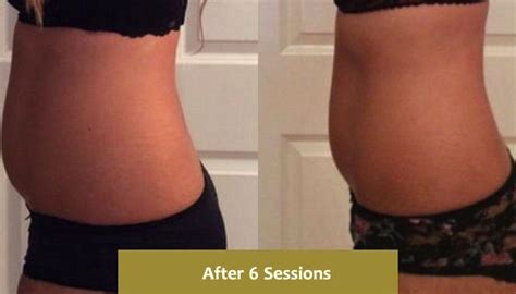 Cavitation Combat Local Fat Dermatology Clinic Dermadvance