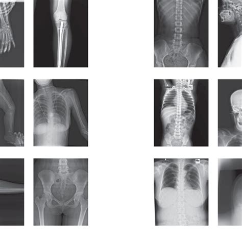 Example Of Valid Left Vs Outlier Right X Ray Images All The Scans Download Scientific