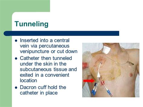 중심정맥관 Central Venous Catheter Picc에 대해서 [종류 합병증 관리 삽입] 네이버 블로그