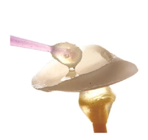 Ceramic Treatment Surface A The Conditioning Of The Veneer With 5