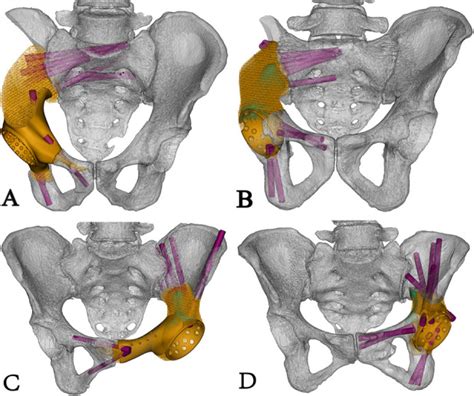 What Are The Complications Of Three Dimensionally Printed Custom Made