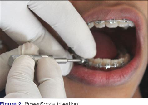 Figure 2 From Powerscope A Class Ii Corrector A Case Report Semantic Scholar