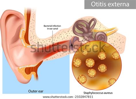 Bacterial Otitis Externa